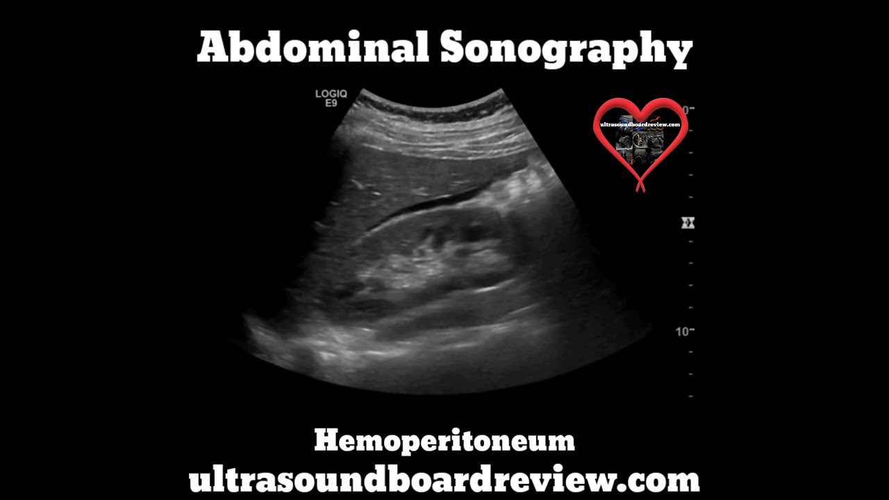 Hemoperitoneum: 5 Key Signs You Should Not Ignore